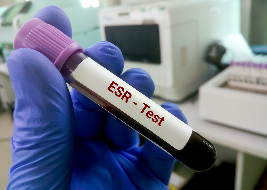 Study examines whether dropping ESR tests actually lowers costs | Stacker